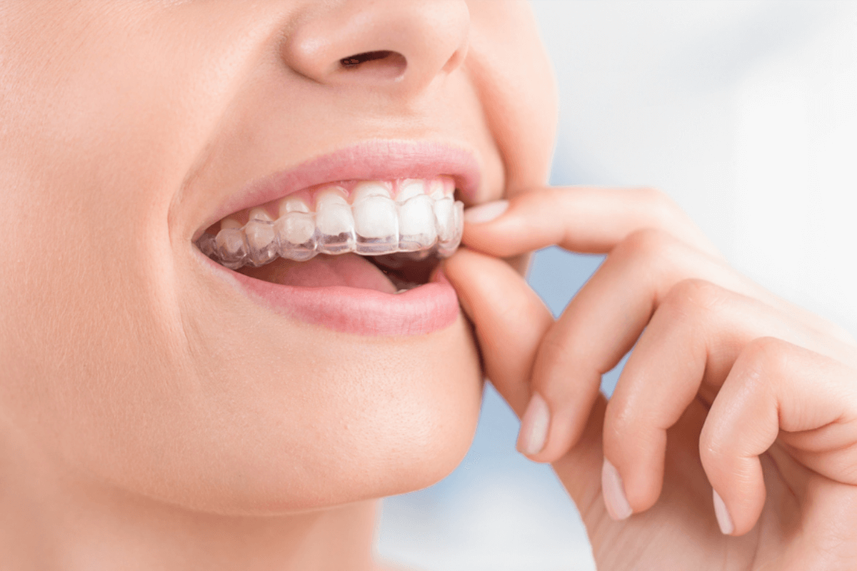 Clear Aligner Therapy - Embrace Orthodontics Prince Albert